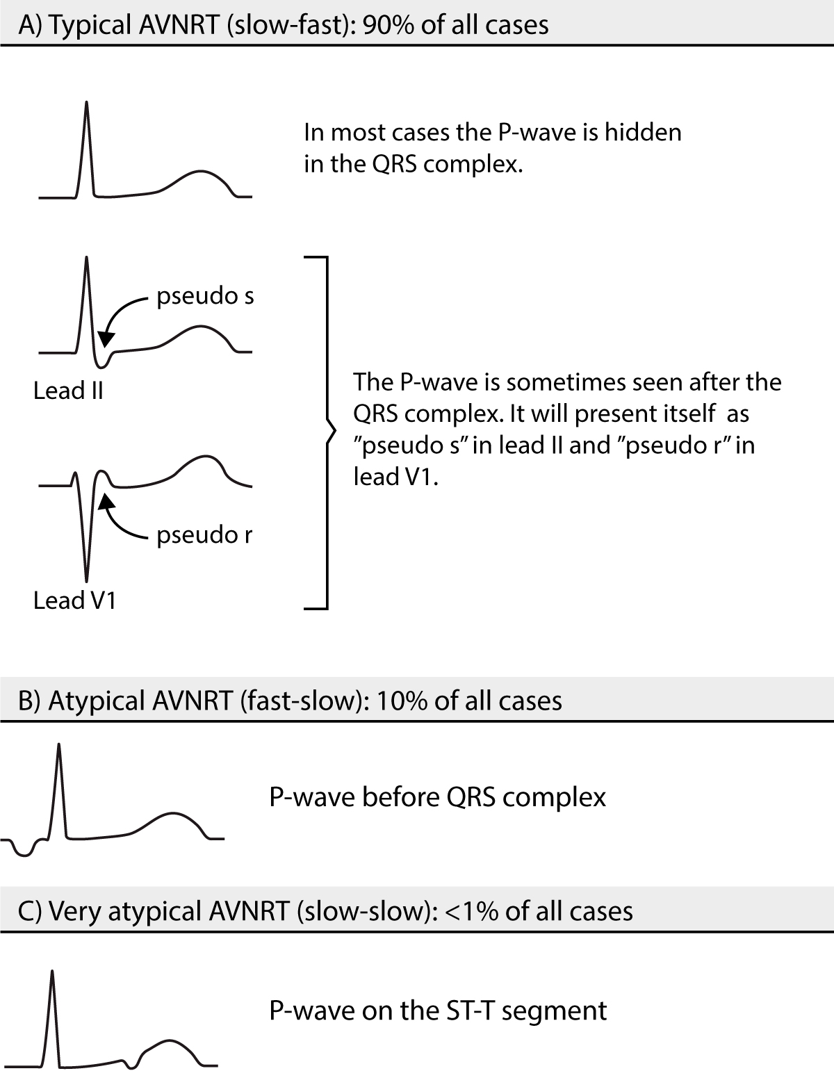 Atrioventrikulær nodal reentry-takykardi (AVNRT): EKG-egenskaber og ...