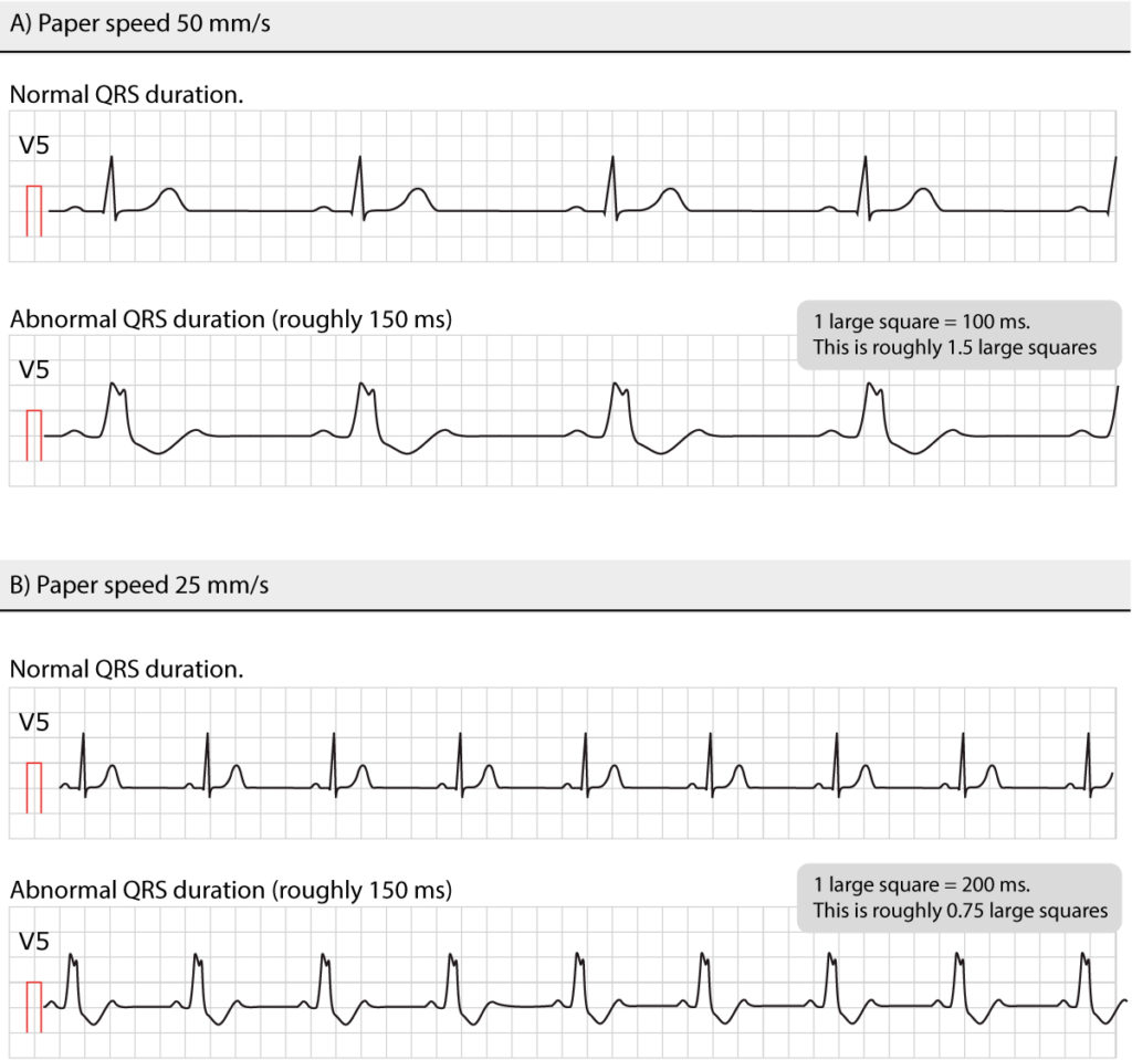 QRS-komplekset: EKG-egenskaber ved Q-bølgen, R-bølgen, S-bølgen og ...