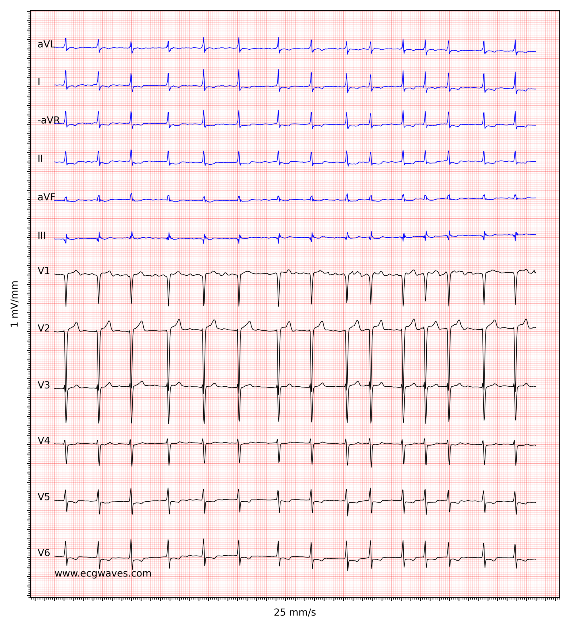 Atrieflimren: EKG, klassifikation, årsager, risikofaktorer og ...