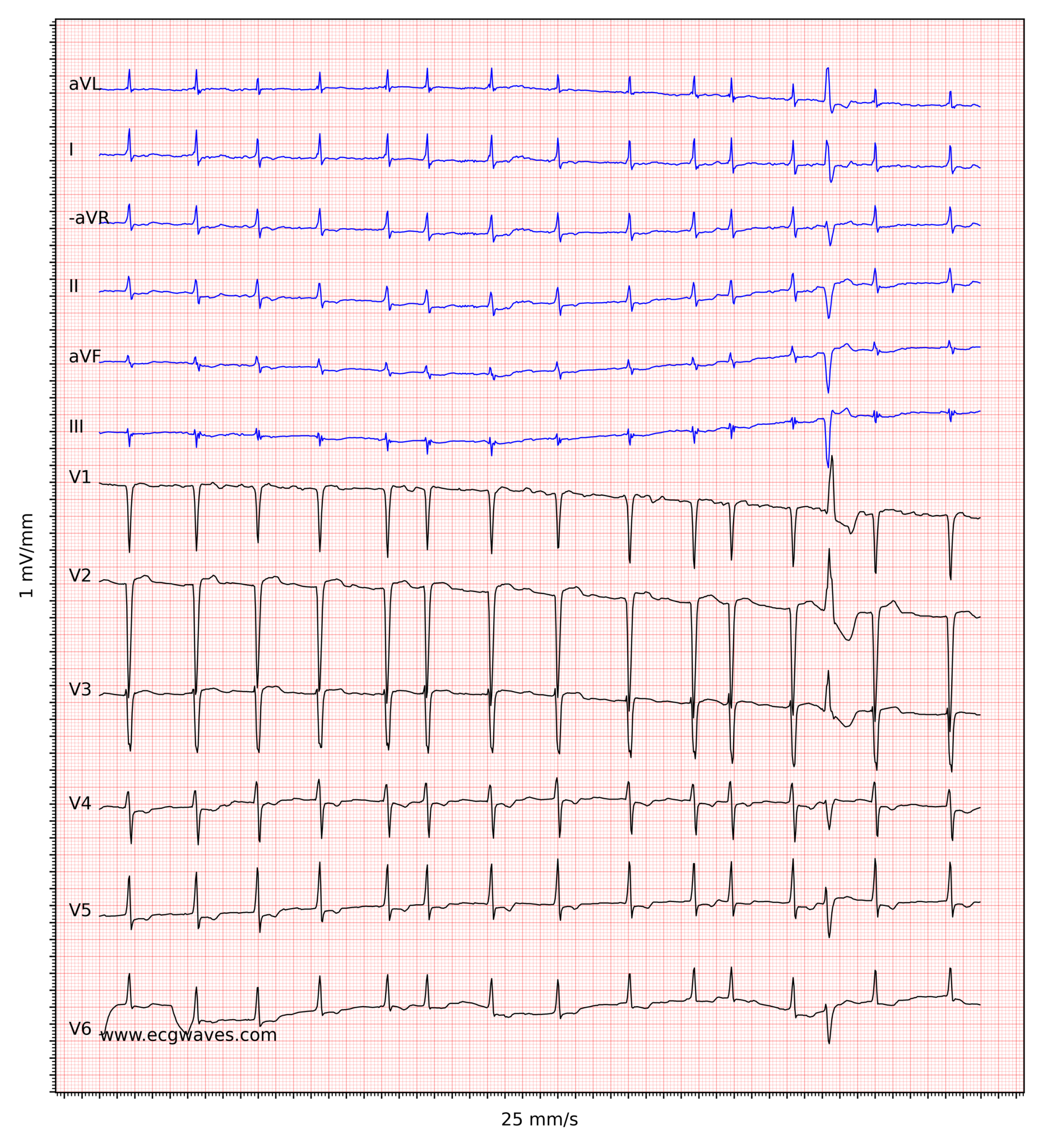 Atrieflimren: EKG, klassifikation, årsager, risikofaktorer og ...