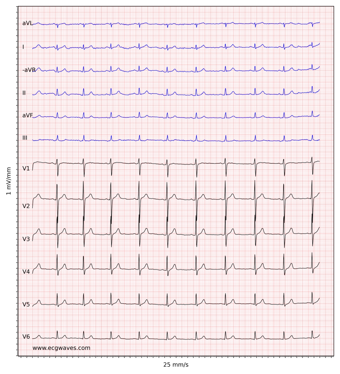 Fortolkning af EKG: Karakteristika for det normale EKG (P-bølge, QRS ...