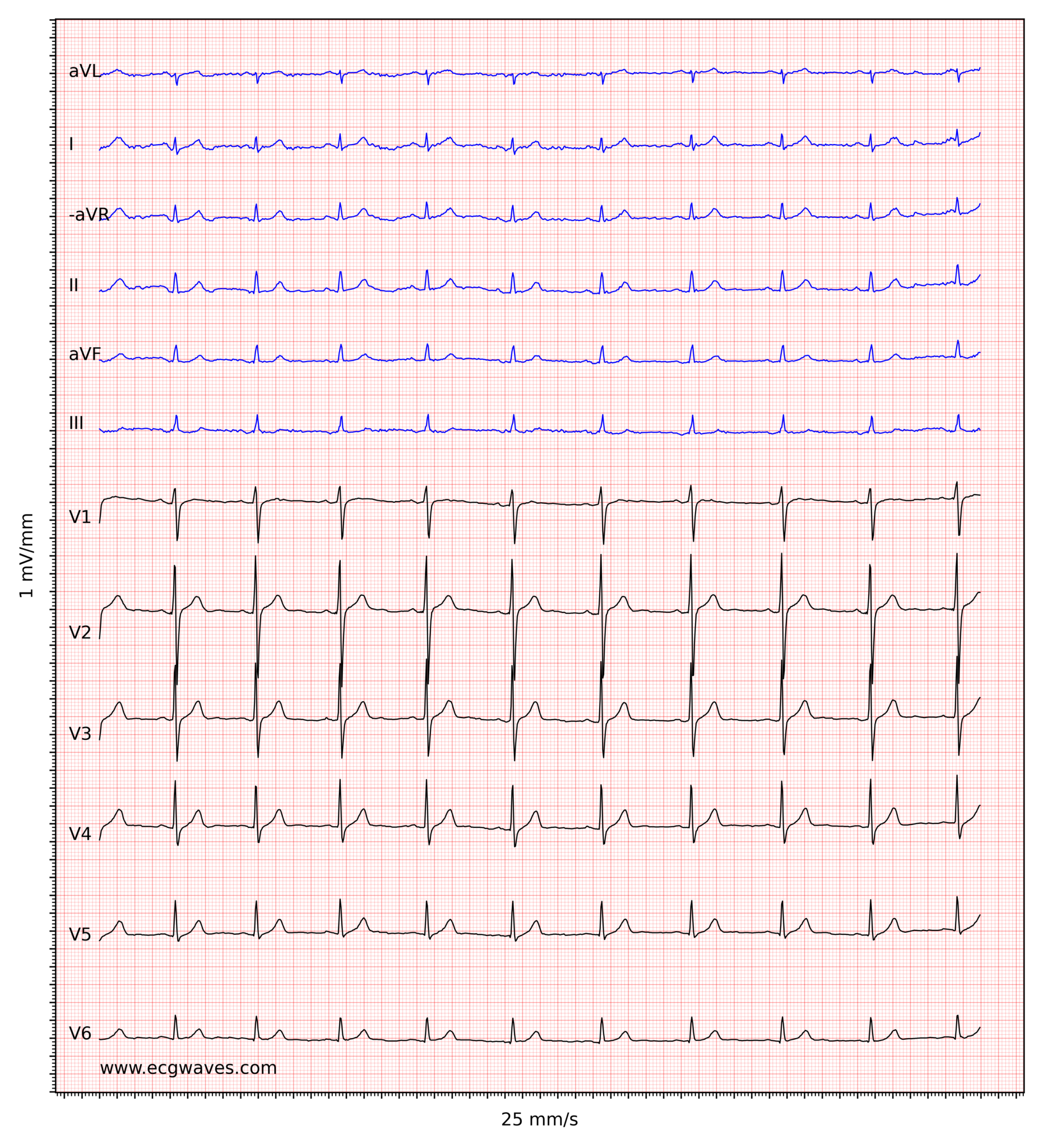 Fortolkning af EKG: Karakteristika for det normale EKG (P-bølge, QRS ...