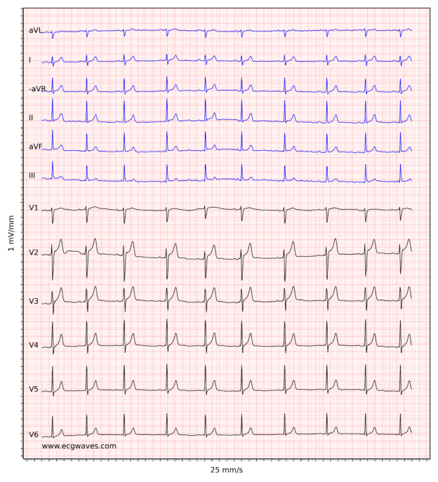 Fortolkning af EKG: Karakteristika for det normale EKG (P-bølge, QRS ...