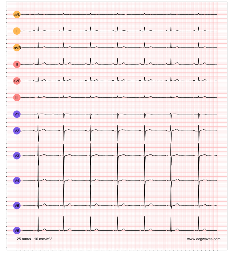 Førstegrads AV-blok (AV-blok I, AV-blok 1) – Kardiologi Online