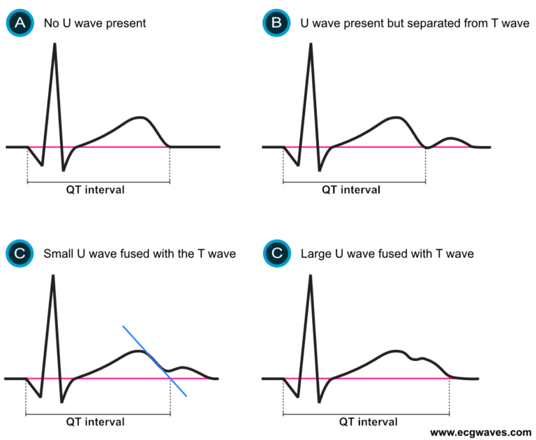QT-varighed og korrigeret QT-varighed (QTc): EKG-egenskaber og konsekvenser
